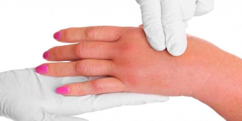 Dedo Inchaço - Causas E Outros Sintomas De Dedos Inchados - PuroMD