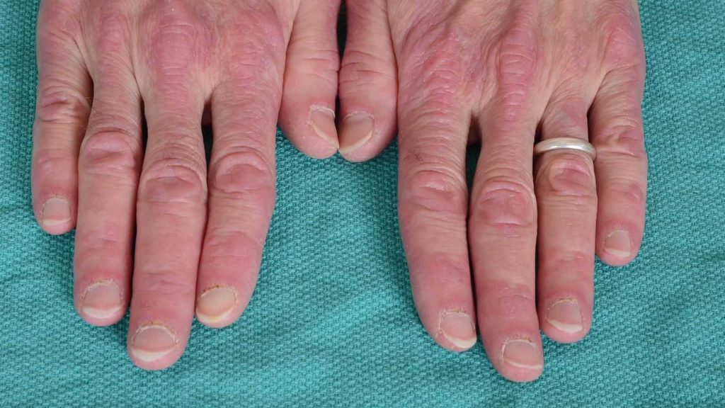 Calcinose Cutis (Depósitos De Cálcio Na Pele) - PuroMD