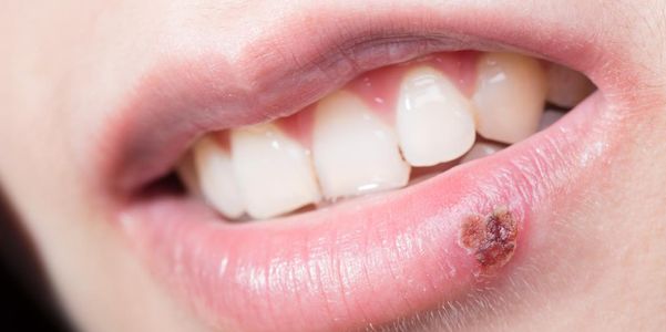 Feridas Nos Lábios (rachaduras, Bolhas, Protuberâncias) Causas - PuroMD