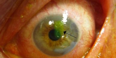 Córnea Riscada (Abrasão Corneana) - PuroMD