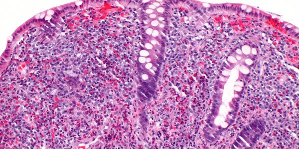 Colite Eosinofílica - PuroMD