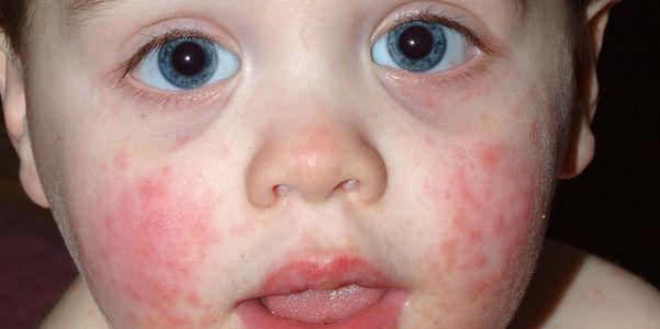 Eczema Do Bebê (bebês, Recém-nascidos) - Causas, Sintomas, Fotos - PuroMD