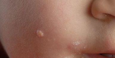 Foliculoma (tumor Do Folículo Piloso) Causas, Sintomas, Tratamento - PuroMD