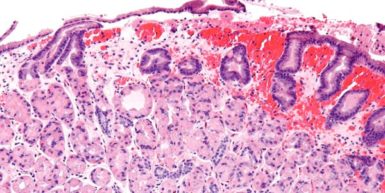 Gastrinoma (tumor Secretor De Gastrina) - PuroMD