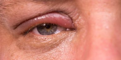 Inflamação Da Pálpebra (blefarite) - PuroMD