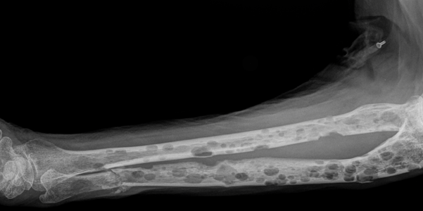 Mieloma Múltiplo - Sintomas E Estadiamento - PuroMD