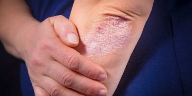 Neurodermatite (Lichen Simplex Chronicus) Erupção Cutânea Crônica - PuroMD