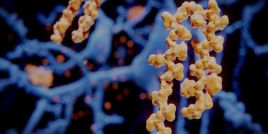 O Que é Amiloidose? Depósitos De Amilóide, Doença, Tipos, Fotos - PuroMD