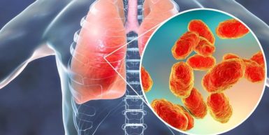 Pneumonia Fúngica (Infecção Pulmonar) Causas, Sintomas, Tratamento - PuroMD