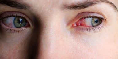 Olhos Inchados - Causas De Inchaço Do Olho E Tratamento - PuroMD