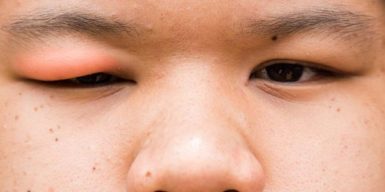 Olhos Inchados - Causas E Remédios Para Inchaço Sob Os Olhos - PuroMD