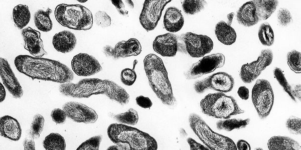 Q Febre (Infecção Por Coxiella Burnetii) - PuroMD