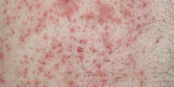 Sintomas De Dermatite De Contato Alérgica, Fotos, Tratamento - PuroMD