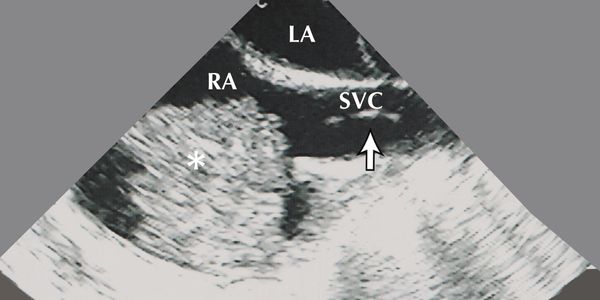 Tumores Cardíacos (Câncer Cardíaco E Crescimento Benigno) - PuroMD