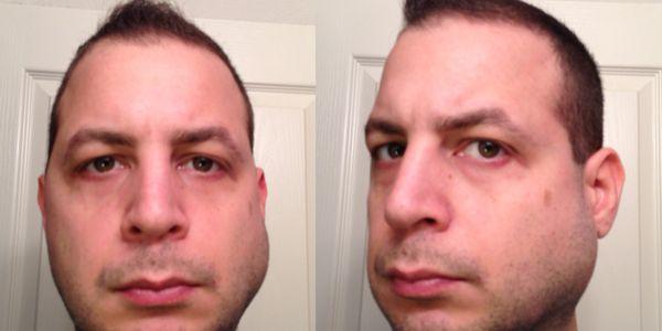 Inchaço Da Glândula Parótida - Causas Da Ampliação Da Parótida - PuroMD