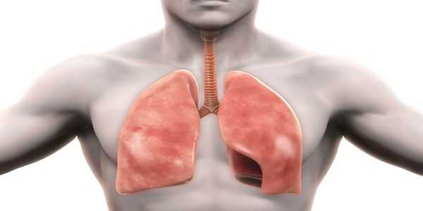 Consolidação Do Pulmão - Sinais, Sintomas E Causas | PuroMD