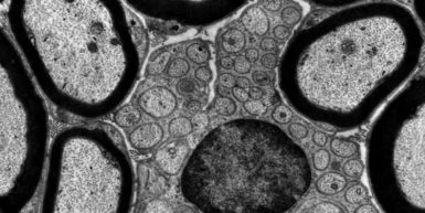 Lesão Do Nervo (Neuropraxia, Axonotmese, Neurotmese) E Cura - PuroMD