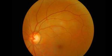 Retinite Pigmentosa Causas, Sintomas, Tratamento - PuroMD