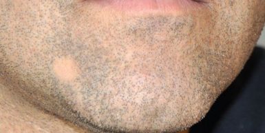 Tinea Barbae (fungo De Barba) Causas, Fotos, Tratamento - PuroMD