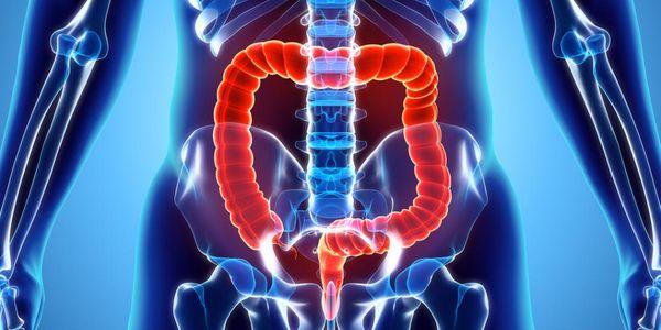 Tipos De Colite E Causas Da Inflamação Do Intestino Grosso - PuroMD